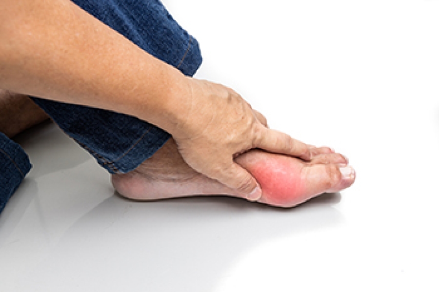 Types and Causes of Gout